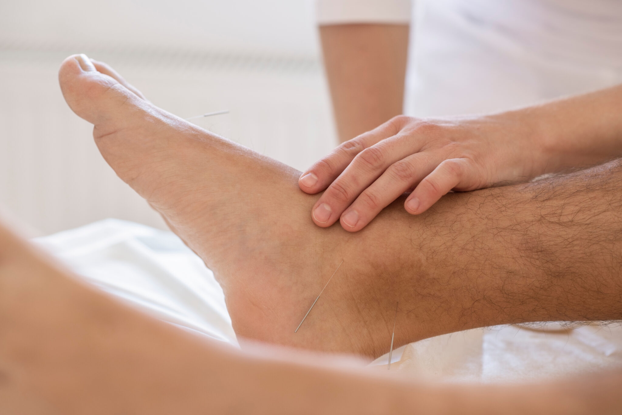 How Dry Needling Relieves Plantar Fasciitis Pain | RVPT